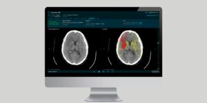 Brainomix Receives FDA Clearance for Its Flagship Stroke AI Imaging ...